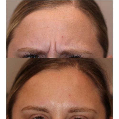 Botox - Destin Medical Spa