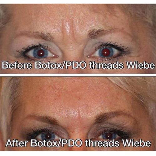 Botox - Destin Medical Spa