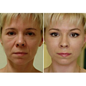 Botox - Destin Botox