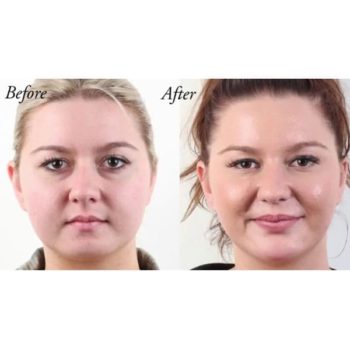 Botox - Destin Botox