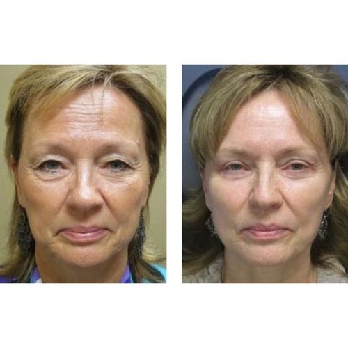 Botox - Destin Botox