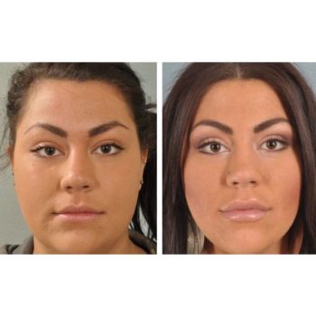 Botox - Destin Botox