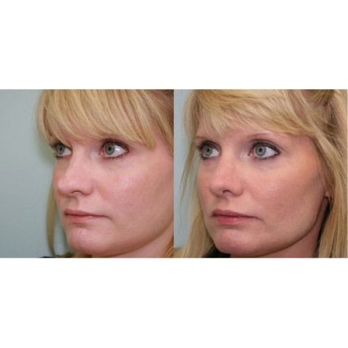 Botox - Destin Medical Spa