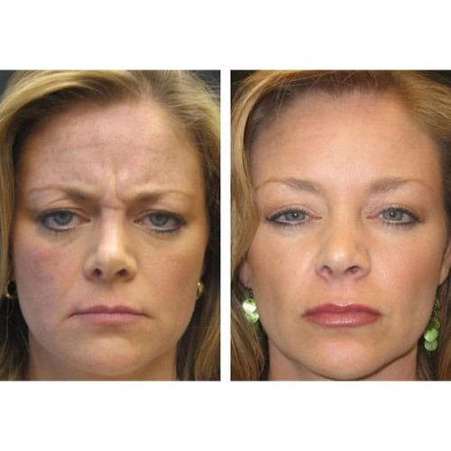 Botox - Destin Medical Spa