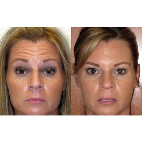 Botox - Destin Medical Spa