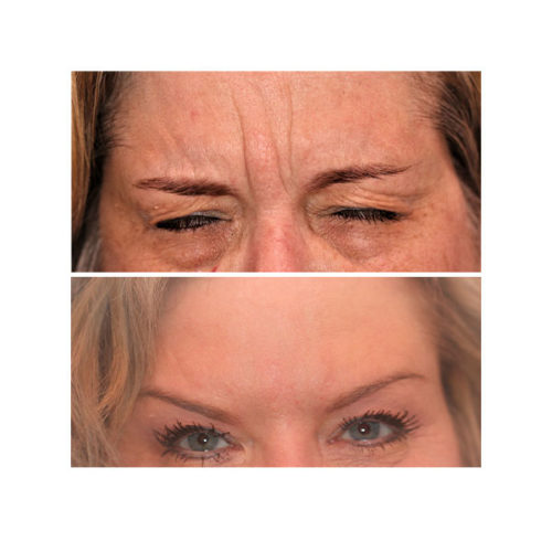 Botox, PDO Threads & Thread Lifts - Destin Medical Spa