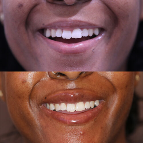 Botox Filler + Lip Flip - Destin Botox