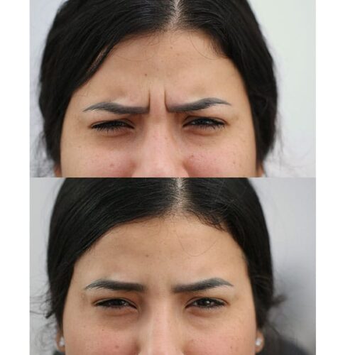 Botox - Destin Medical Spa